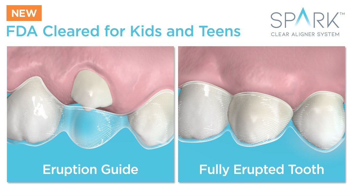 Spark Clear Aligners Receive New FDA Approval - Dental Industry News ...