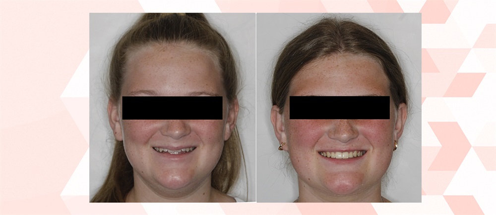 A Voice in the Arena: Aesthetic Importance of Upper Incisor Vertical ...