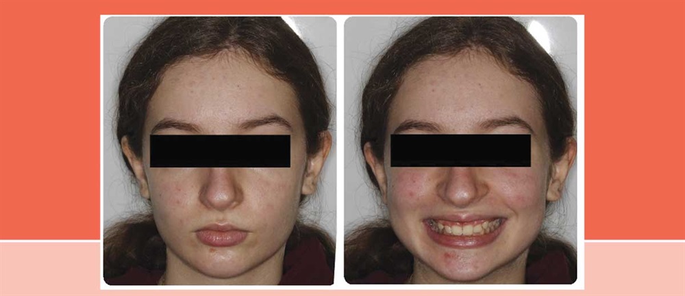 A Voice in the Arena: Lip Trapping by Dr. Chad Foster - Orthotown