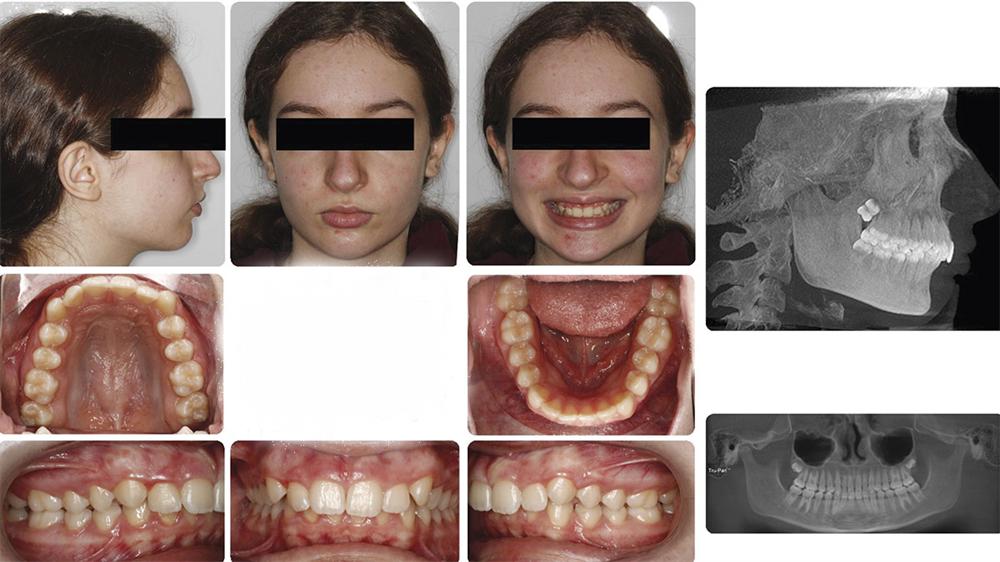 A Voice in the Arena: Lip Trapping by Dr. Chad Foster - Orthotown