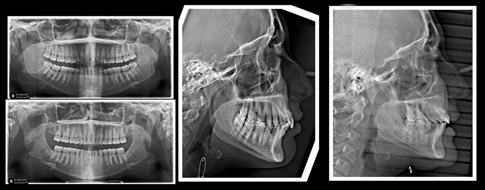 TAD Max by Dr. Wassim Bouzid - Orthotown