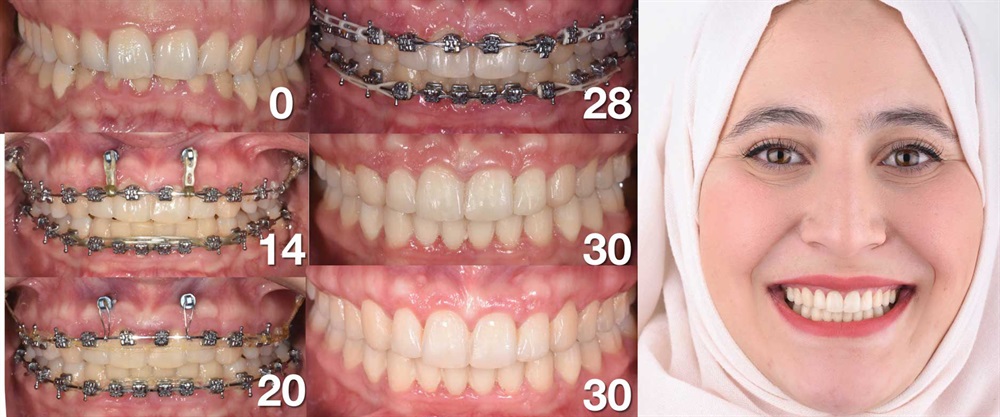 TAD Max by Dr. Wassim Bouzid - Orthotown