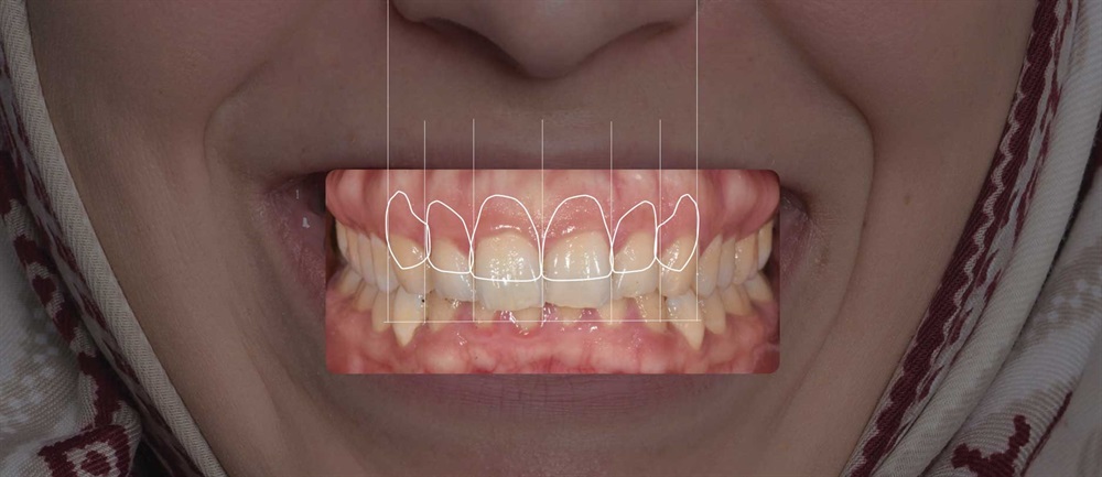 TAD Max by Dr. Wassim Bouzid - Orthotown