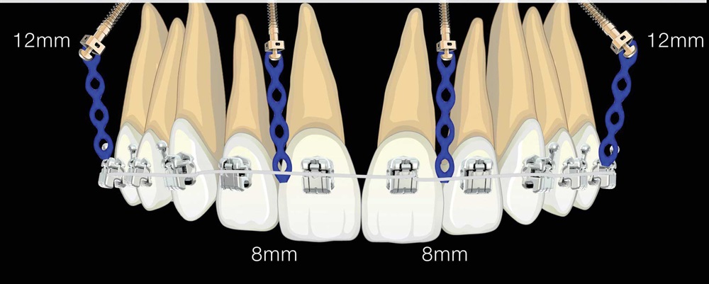 TAD Max by Dr. Wassim Bouzid - Orthotown
