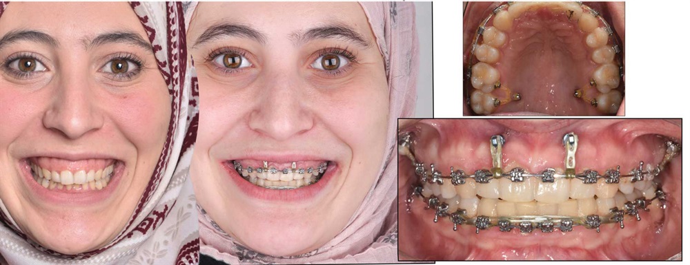 TAD Max by Dr. Wassim Bouzid - Orthotown