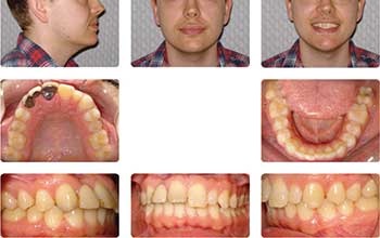 Managing Missing U2s With Clear Aligners by Dr. Jonathan Nicozisis ...