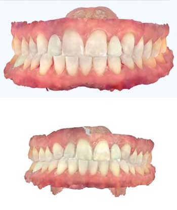Managing Missing U2s With Clear Aligners by Dr. Jonathan Nicozisis ...