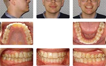 Managing Missing U2s With Clear Aligners by Dr. Jonathan Nicozisis ...