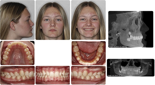 ‘Short-Face’ Patients—Part 2 by Dr. Chad Foster - Orthotown