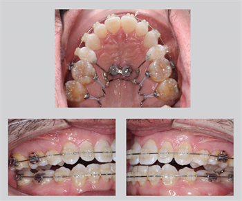 Use of the Multi-Tooth Intruder for Maxillary Posterior Intrusion and ...